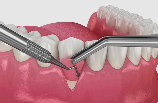 Gum Recession Surgeries Tustin CA - Larwin Square Dentistry