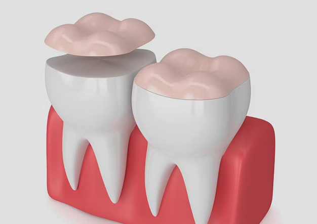 Inlays & Onlays Tustin CA- Larwin Square Dentistry