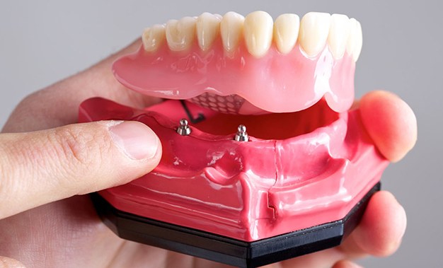 Mini Implants Tustin CA - Larwin Square Dentistry