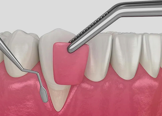 Periodontal Pocket Surgery Tustin CA - Larwin Square Dentistry