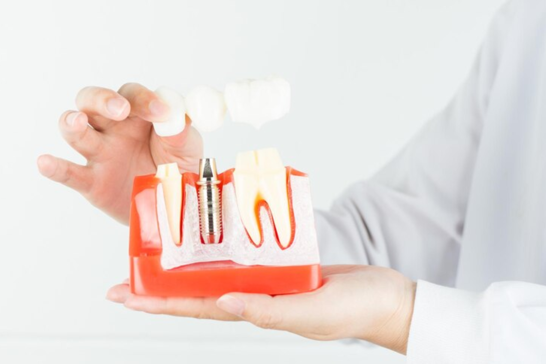 How To Make Your Dental Implants Look Amazing In 9 Days?