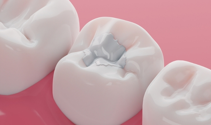 Everything You Need To Know About Gingivectomy