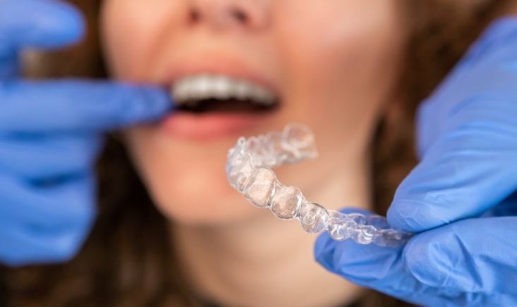 How To Keep Your Invisalign Aligners Clean?