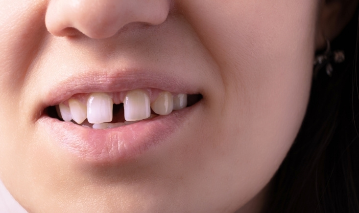 What Is the Reason for Teeth Gaps? Causes & Treatments